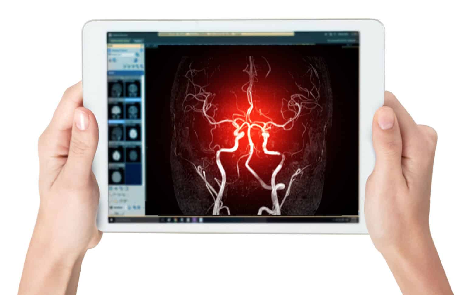 Aneurysmen Ursachen, Symptome, Diagnostik & Behandlung
