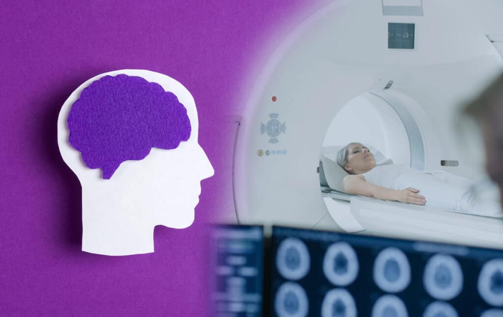 Schlaganfall Ursachen, Symptome & Behandlung des Apoplex