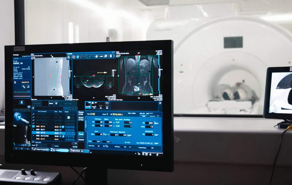 Lymphszintigraphie Lymphflüssigkeit & Wächterknoten abbilden